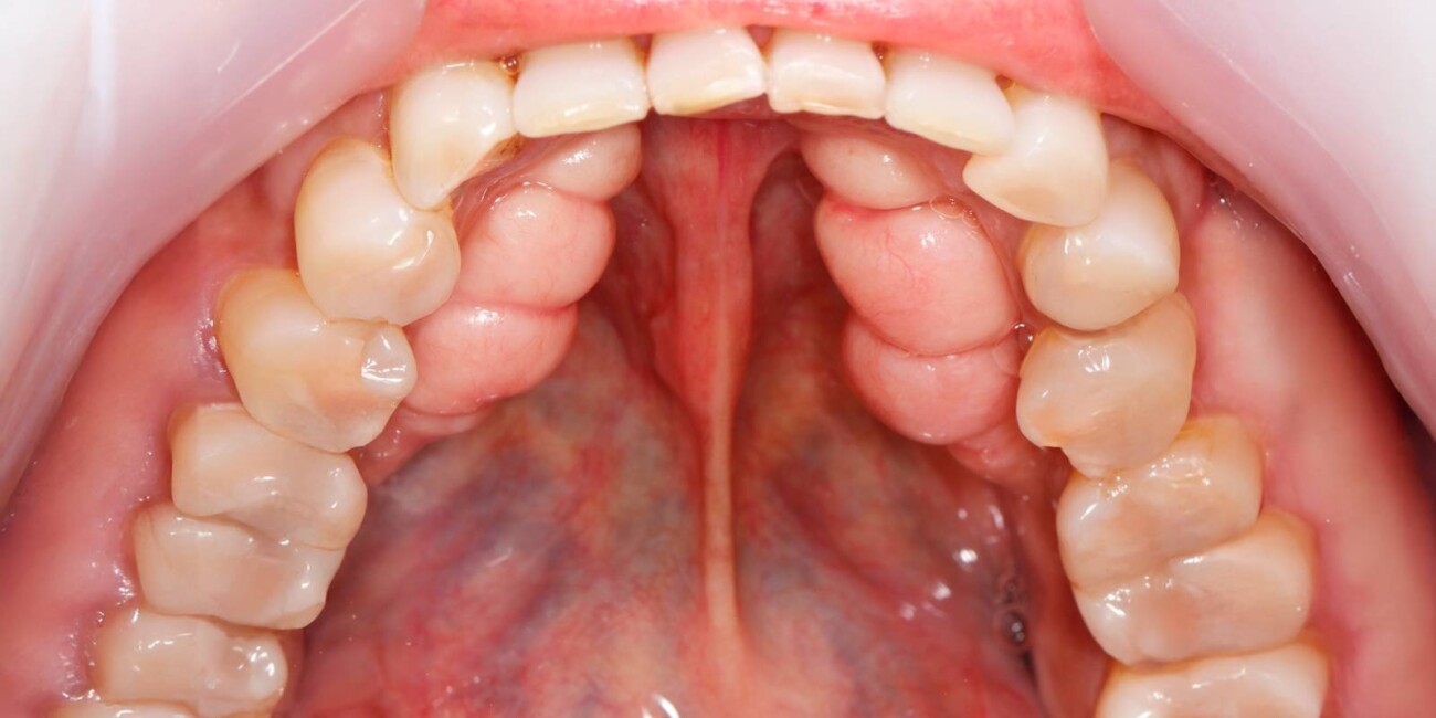 Torus mandibular ¿es un tumor?